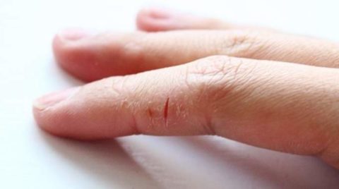 Quelques astuces pour dire adieu aux crevasses des mains